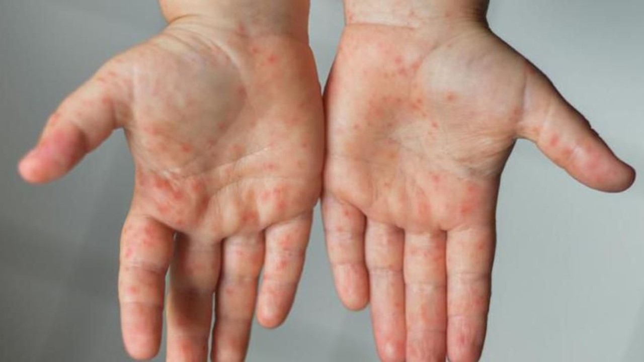 Mga hospital sa bansa, handa na para sa monkeypox – DOH - RMN Networks