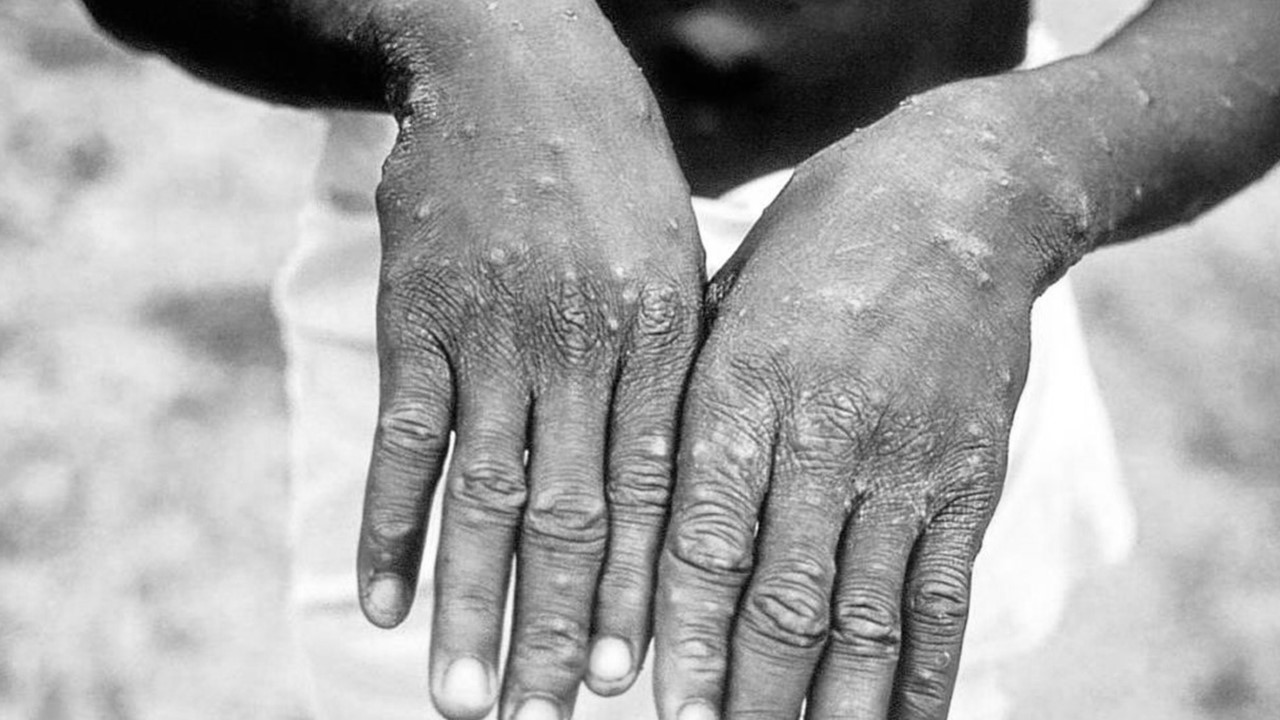 Mga suspected cases ng monkeypox na nasuri ng Philippine Genome Center ...