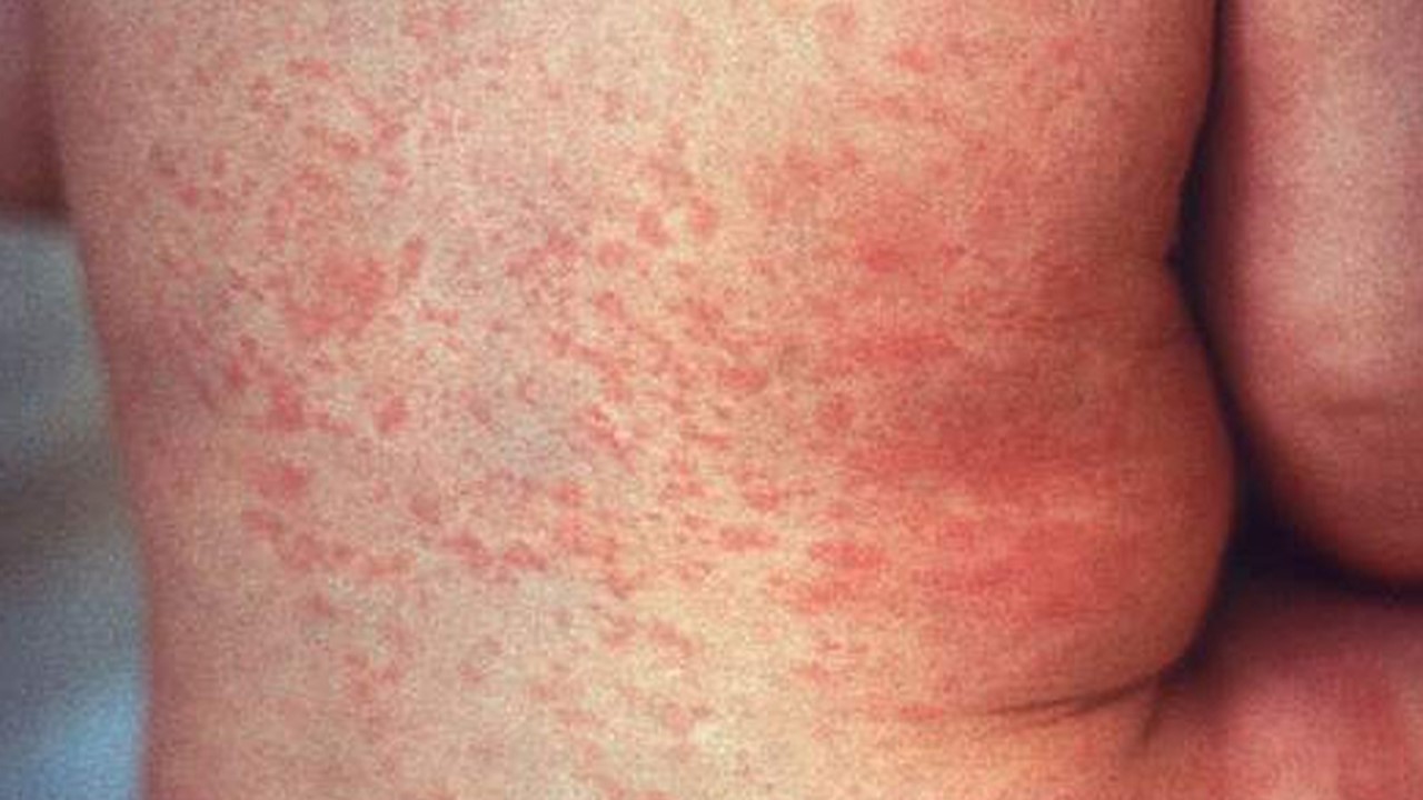 Kaso ng tigdas sa bansa, tumaas ng 201% ngayong taon - DOH - RMN Networks